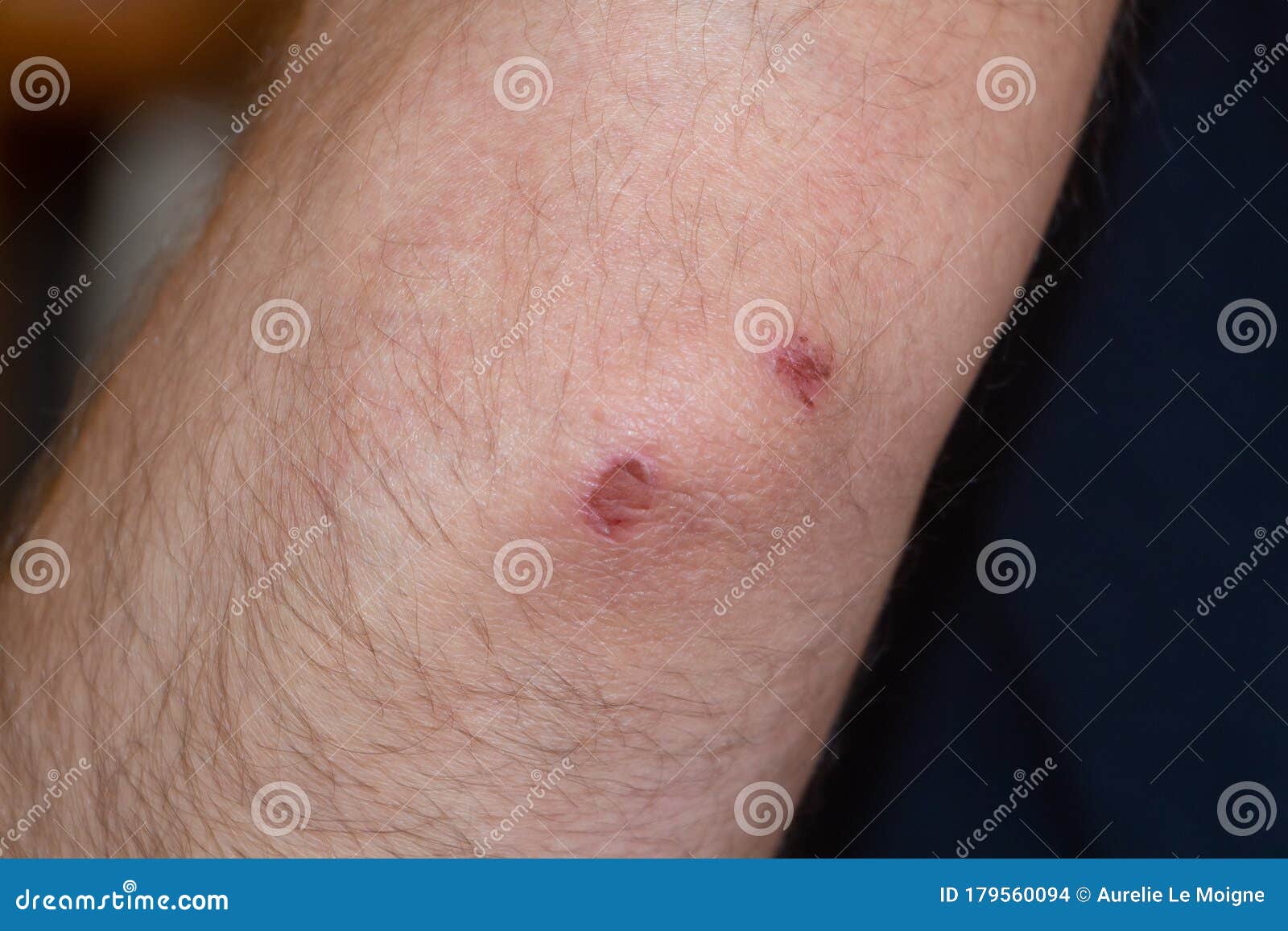 Elbow grazed stock photo. Image of blood, wound, pain - 179560094