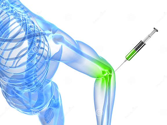 Elbow injection stock illustration. Illustration of bursitis - 19132708