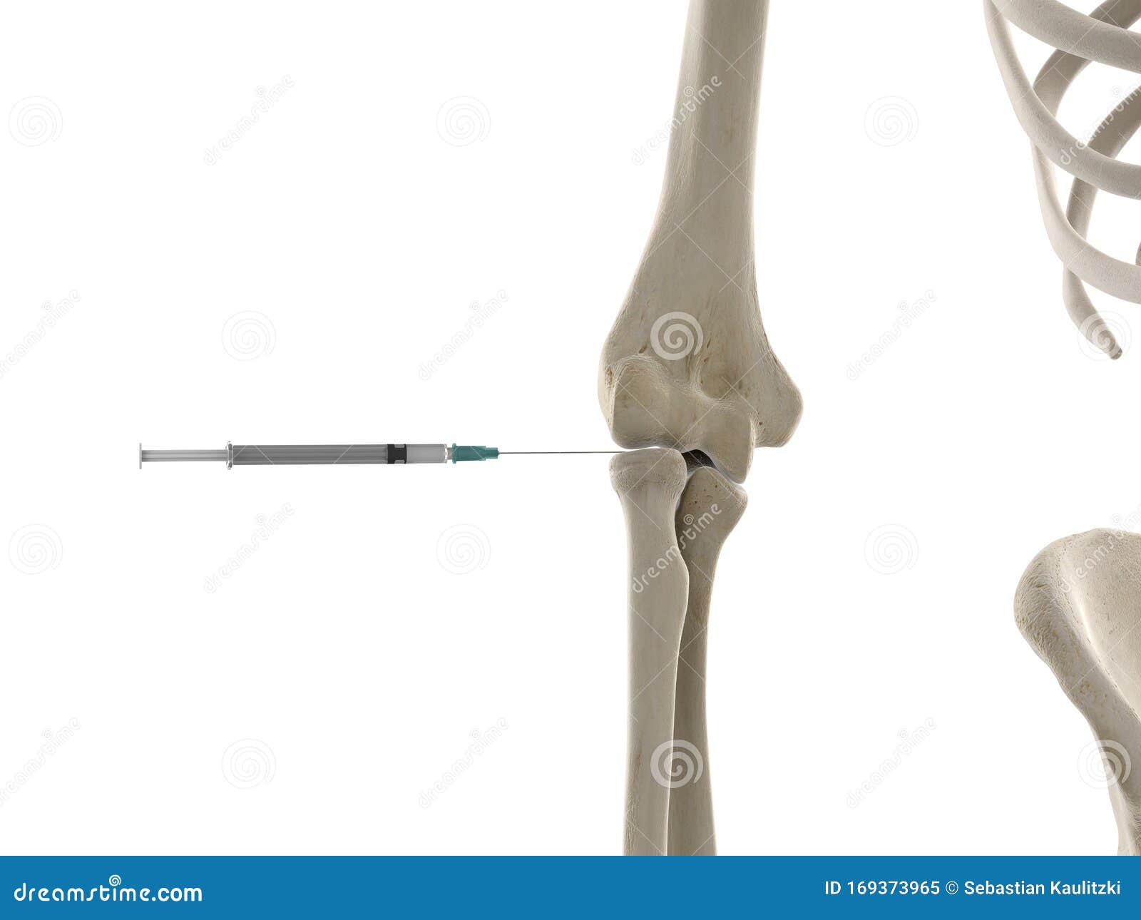 An elbow injection stock illustration. Illustration of accurate - 169373965