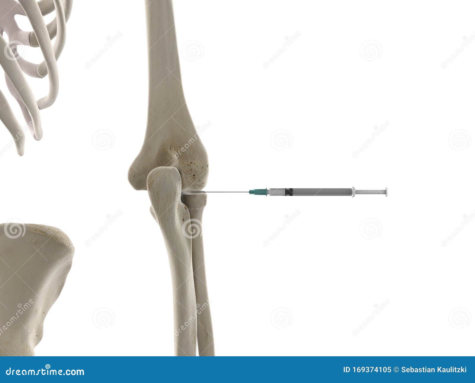 An elbow injection stock illustration. Illustration of rendering ...
