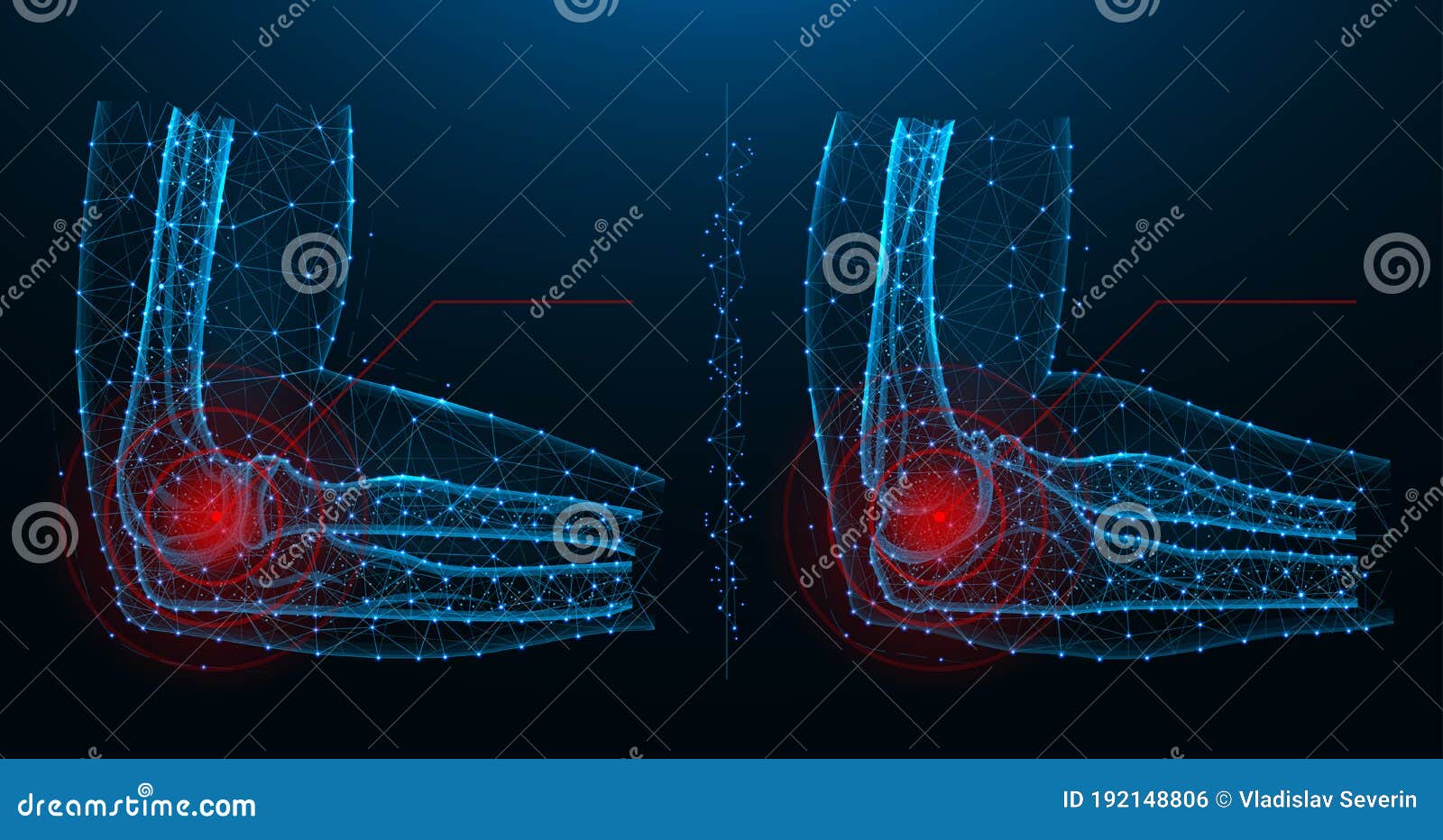 Elbow joint pain stock vector. Illustration of glow - 192148806