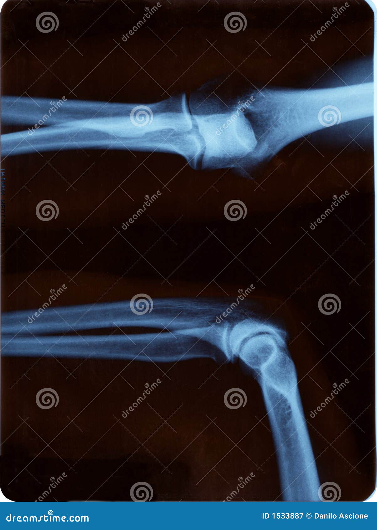 Elbow radiography stock image. Image of hospital, doctor - 1533887