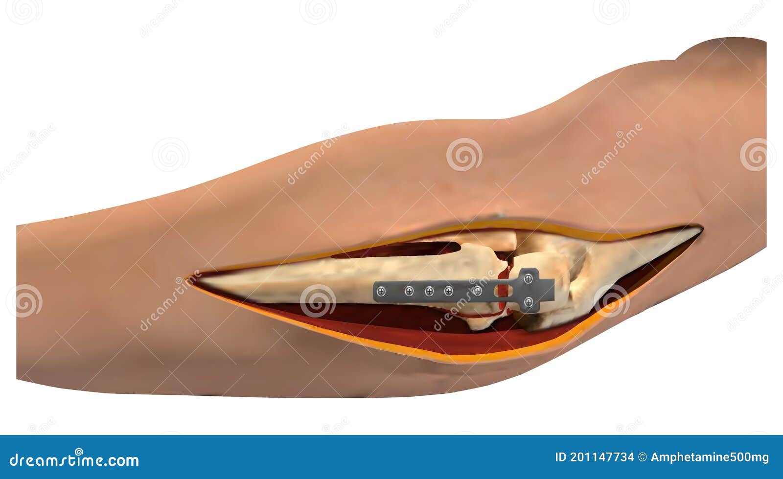 Elbow surgery fixation stock illustration. Illustration of elbow ...