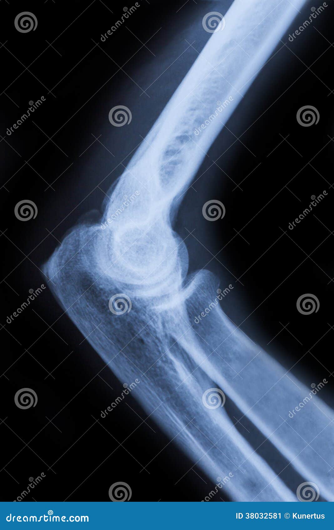 Elbow X Ray Royalty-Free Stock Photo | CartoonDealer.com #38032581
