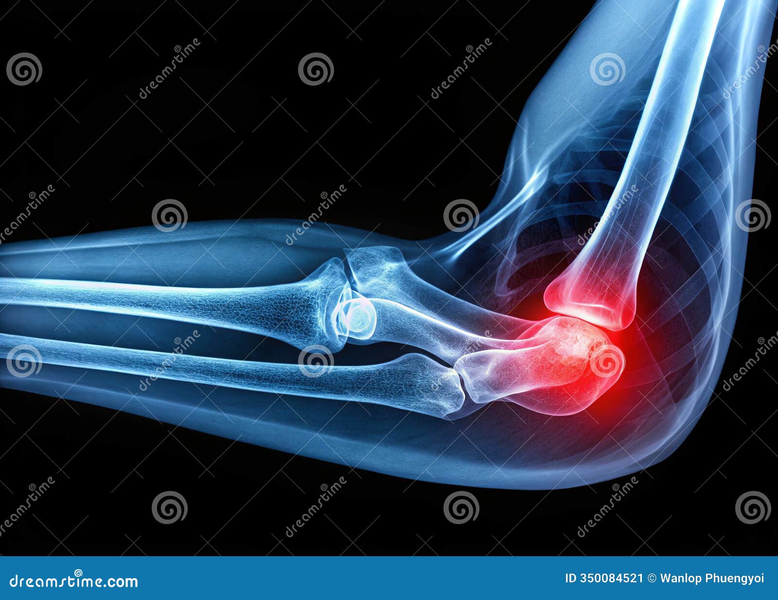 Elbow XRay Assessing Minor Sprain With Bone Edema Stock Image ...
