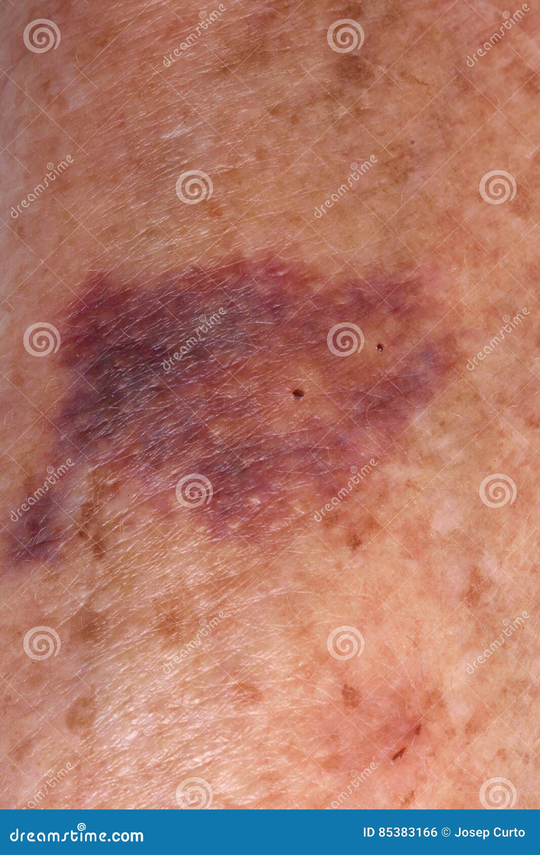 Aging Skin Ecchymosis