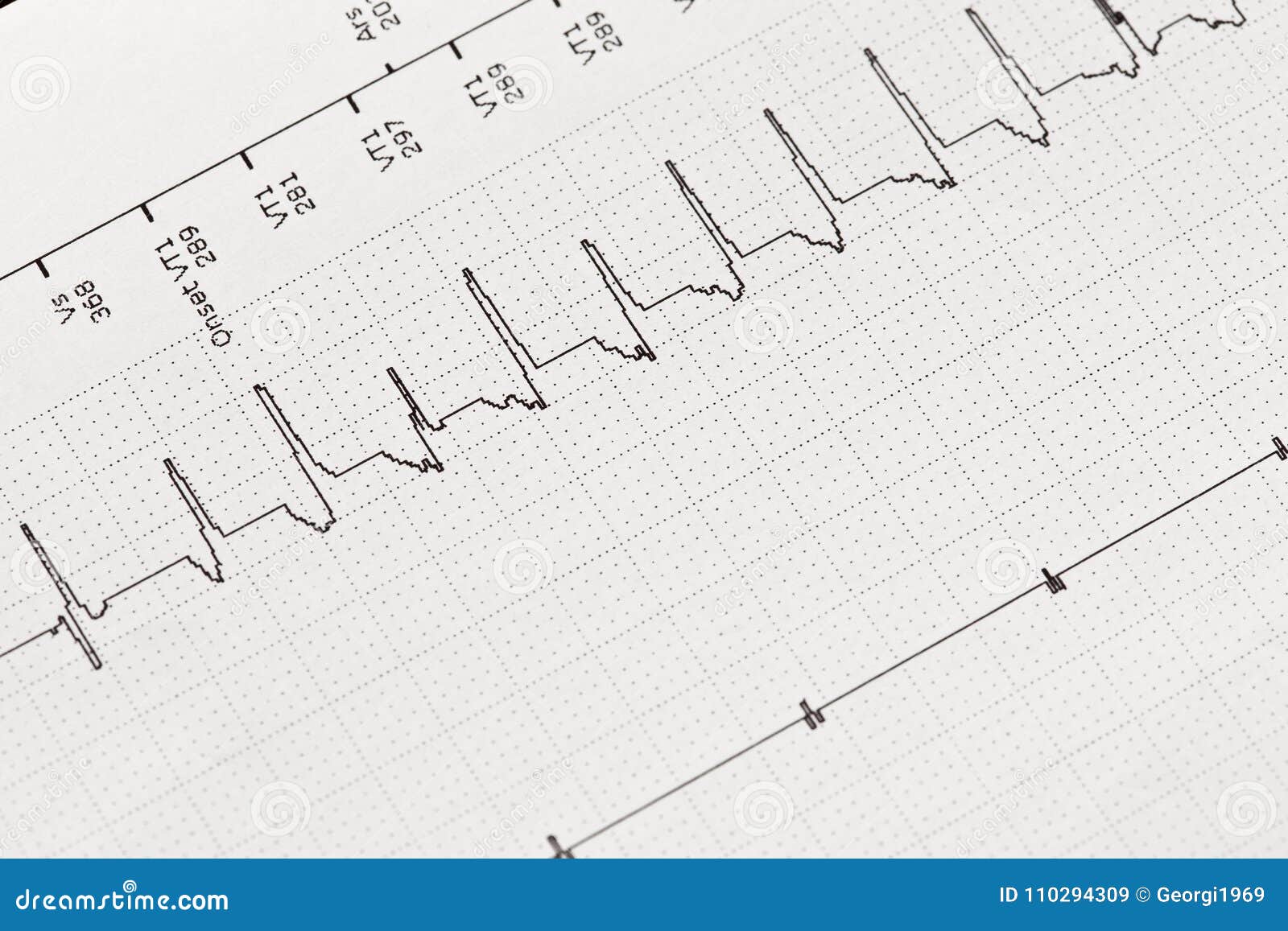 Electrocardiogram, Cardiac Arrhythmia Stock Image - Image of internal ...