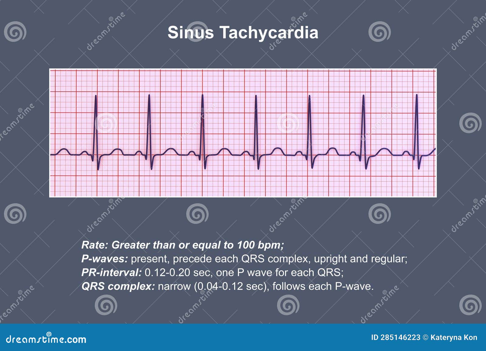 Electrocardiogram Displaying Sinus Tachycardia, 3D Illustration ...