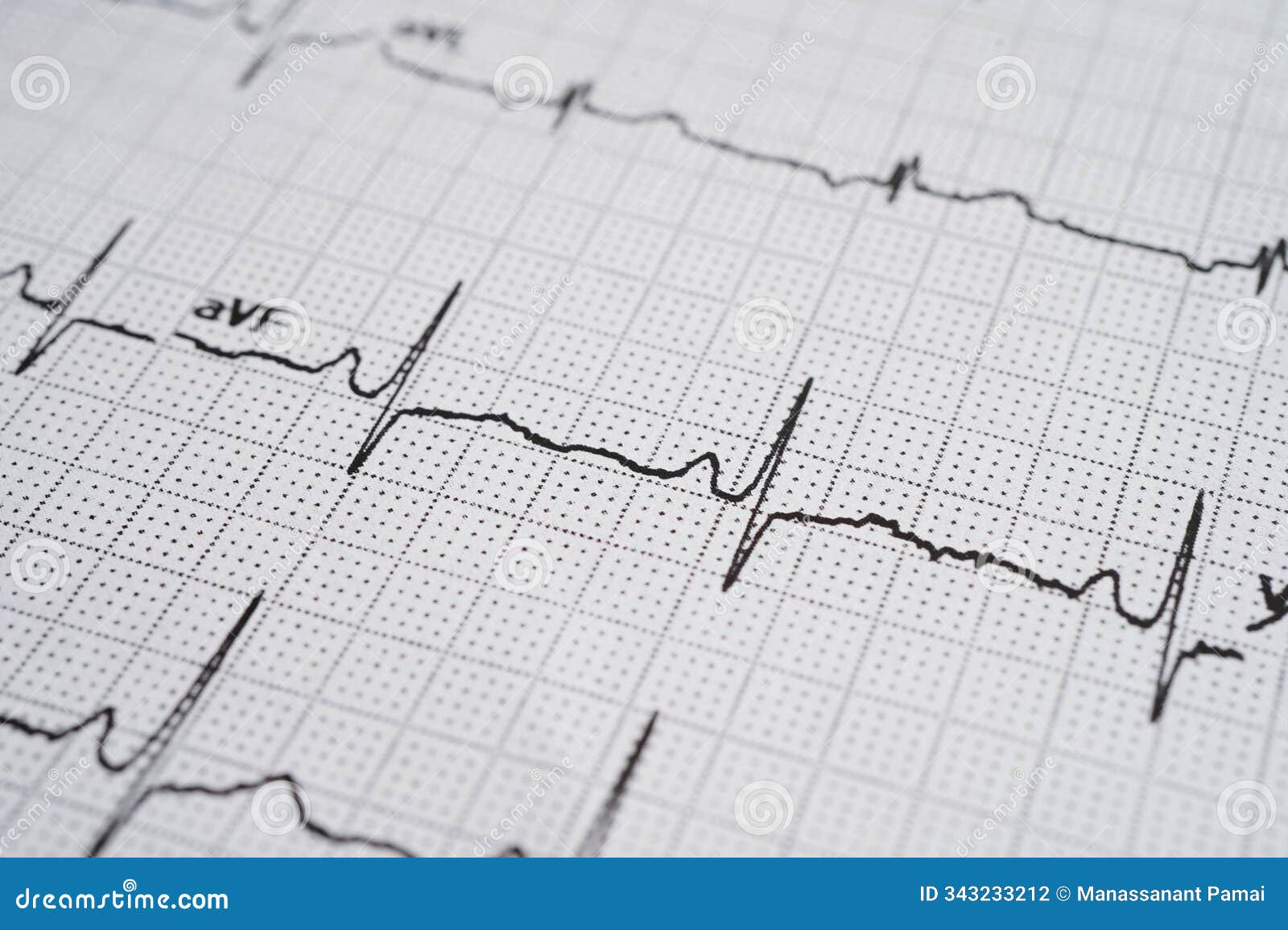 Electrocardiogram (ECG), Heart Wave, Heart Attack, Cardiogram Report ...