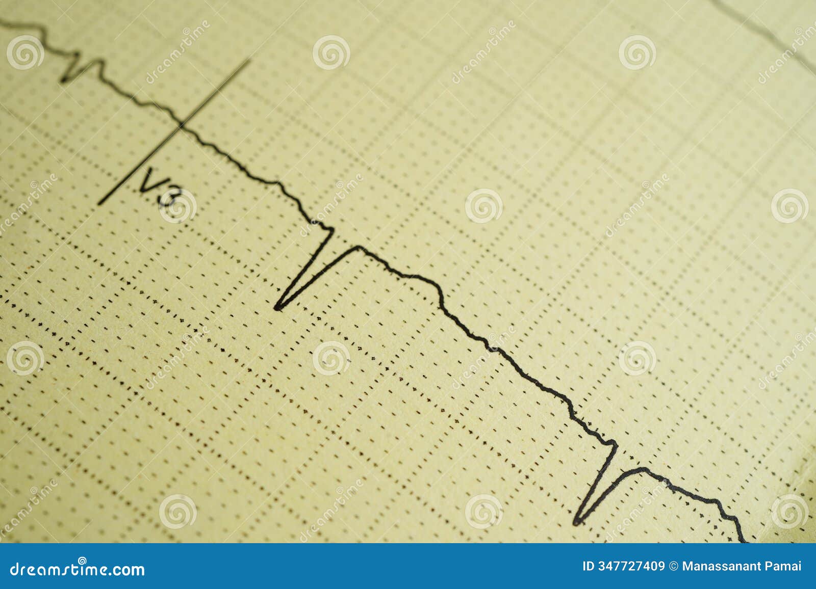 Electrocardiogram (ECG), Heart Wave, Heart Attack, Cardiogram Report ...