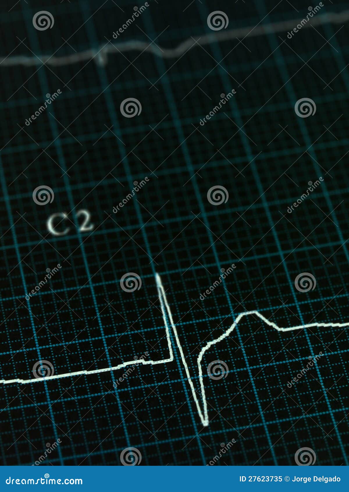Electrocardiogram ECG In A Graph Paper Shows Normal Sinus Rhythm, Vital ...