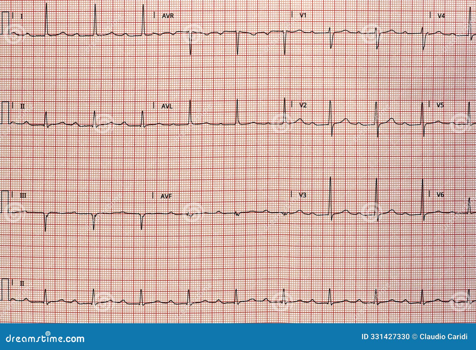 Electrocardiogram in Paper Form. Analog Electrocardiographic Recording ...