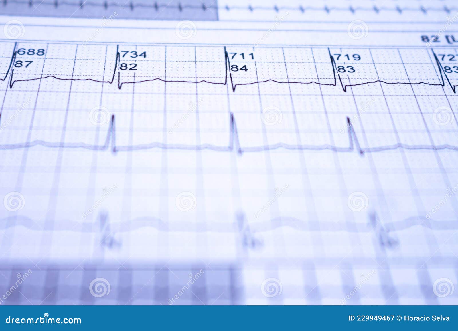 Electrocardiogram Recorded on Graph Paper. Study of the Human Heart ...