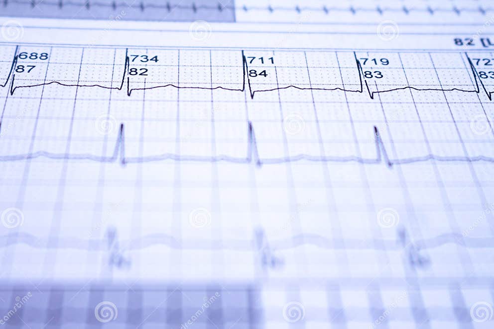 Electrocardiogram Recorded on Graph Paper. Study of the Human Heart ...