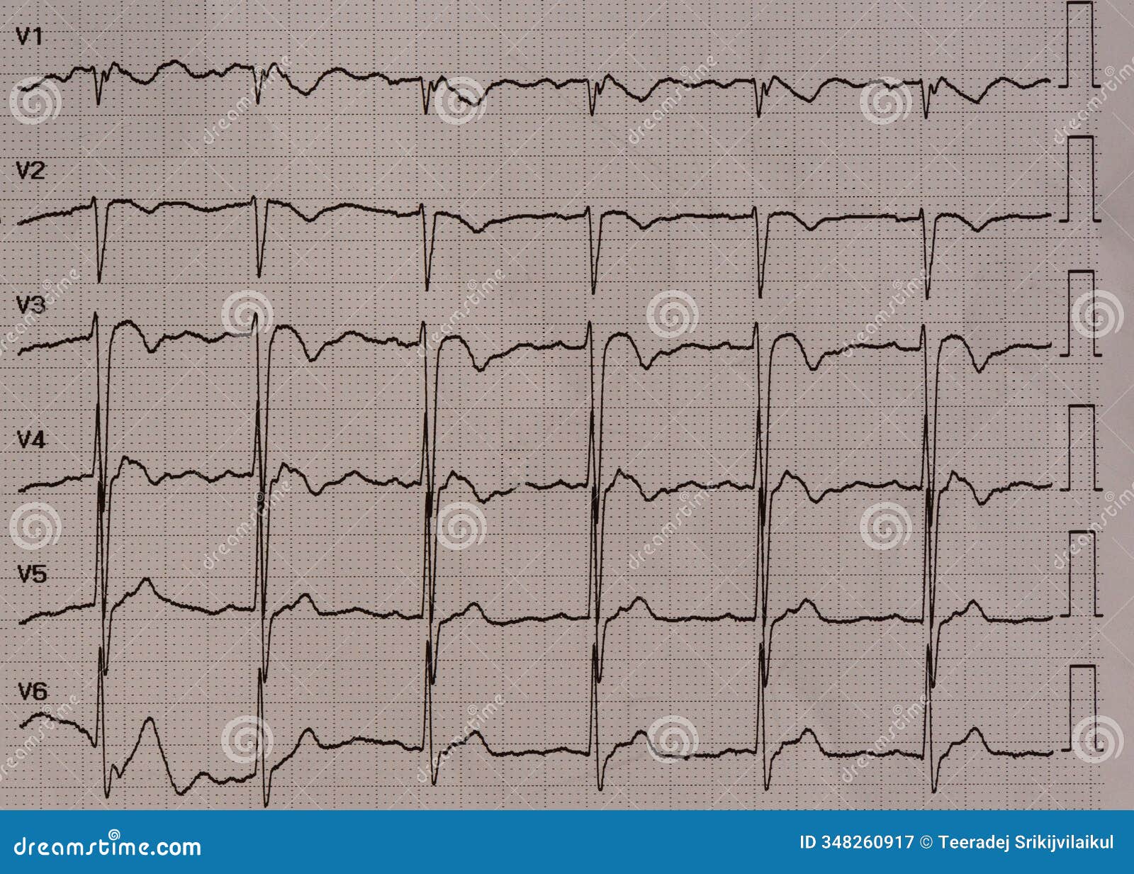Electrocardiogram Showing Heart Rhythm Patterns Suggestive Myocardial ...