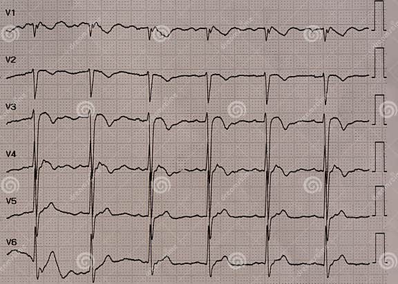 Electrocardiogram Showing Heart Rhythm Patterns Suggestive Myocardial ...