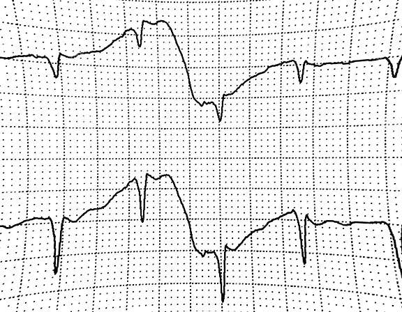 Electrocardiogram Test that Shows Electrical Activity of the Heart ...