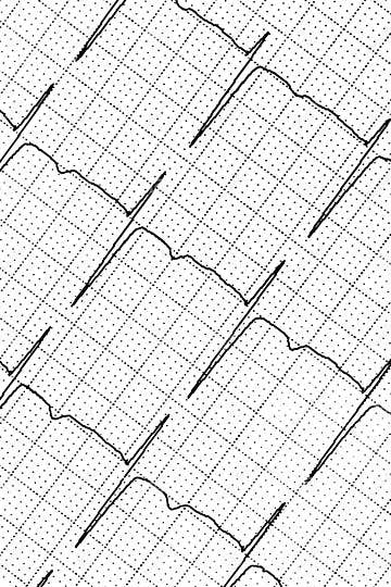 Electrocardiogram Test that Shows Electrical Activity of the Heart ...