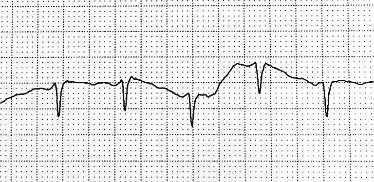 Electrocardiogram Test that Shows Electrical Activity of the Heart ...