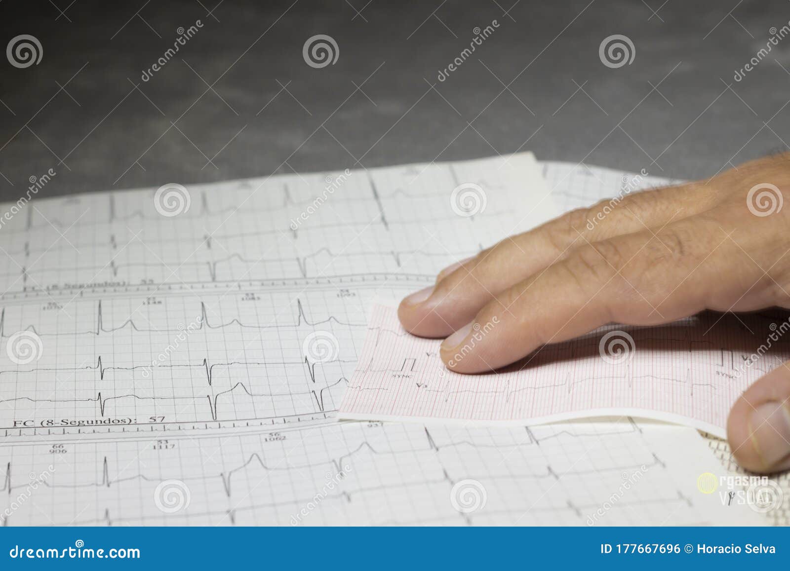 Electrocardiogram Strips with Selective Focus. Paper Traces of the ...