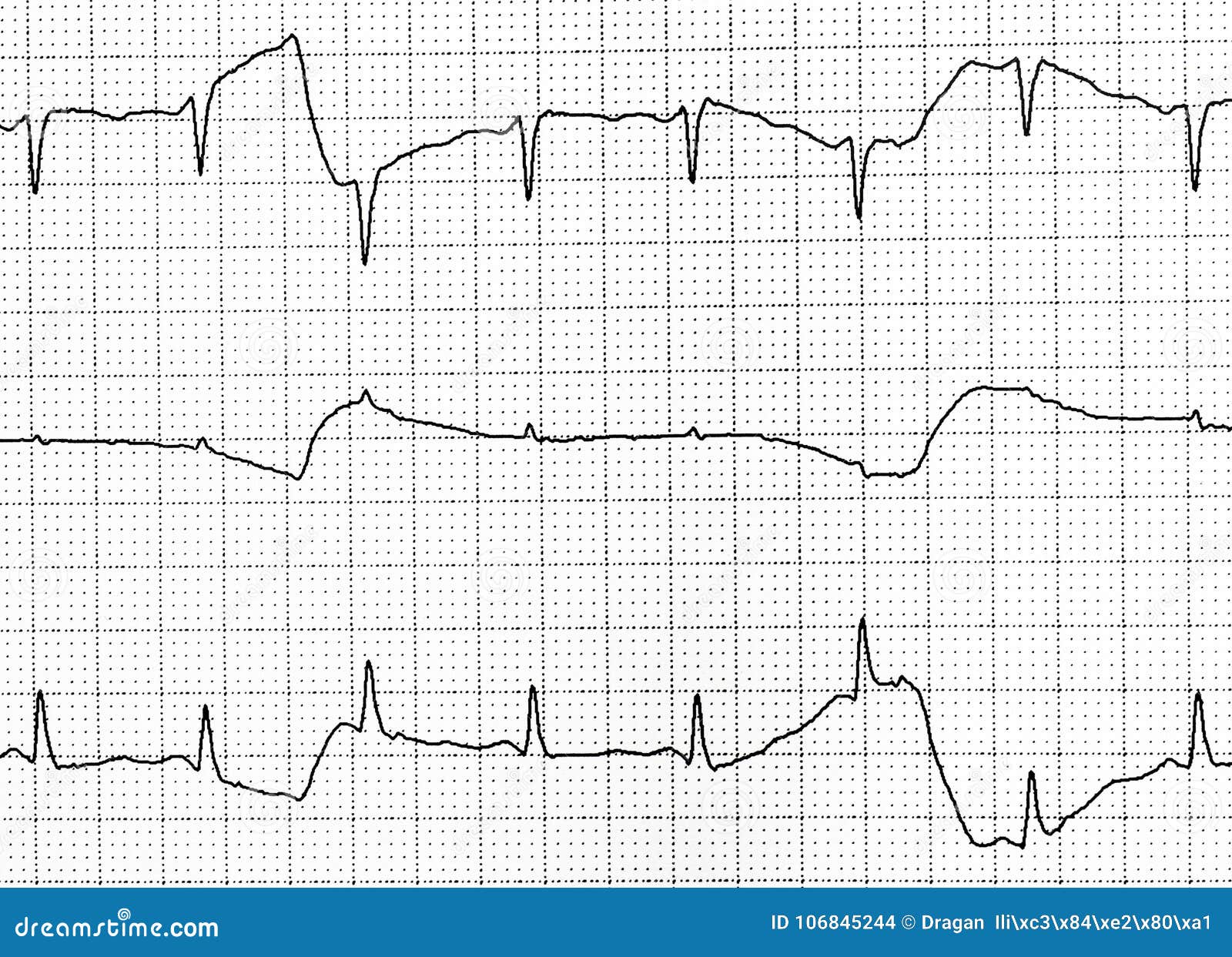 Electrocardiogram Test that Shows Electrical Activity of the Heart ...
