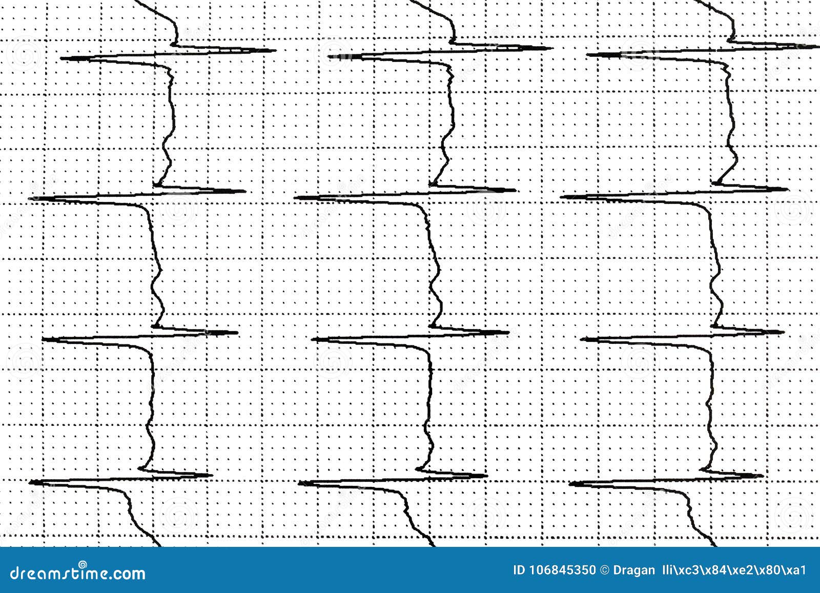Electrocardiogram Test that Shows Electrical Activity of the Heart ...