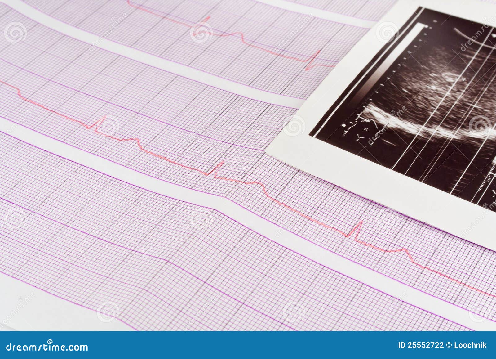 Electrocardiogram and Ultrasound Shot Stock Photo - Image of medical ...