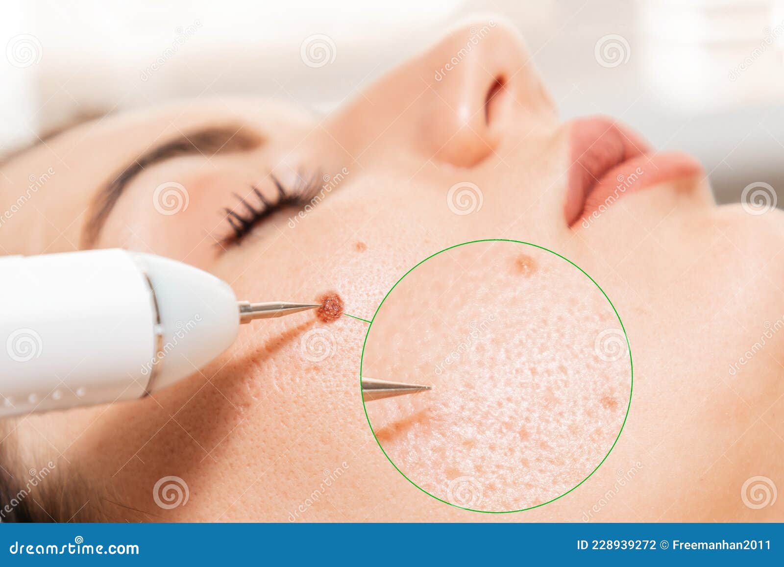 Electrocoagulation And Laser Cosmelotogy Dermatologist Surgeon Using A