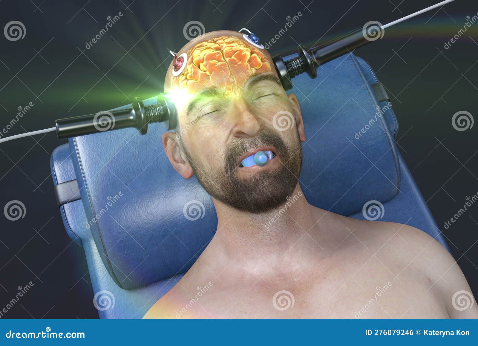 Electroconvulsive Therapy, ECT, a Treatment Involving the Use of ...