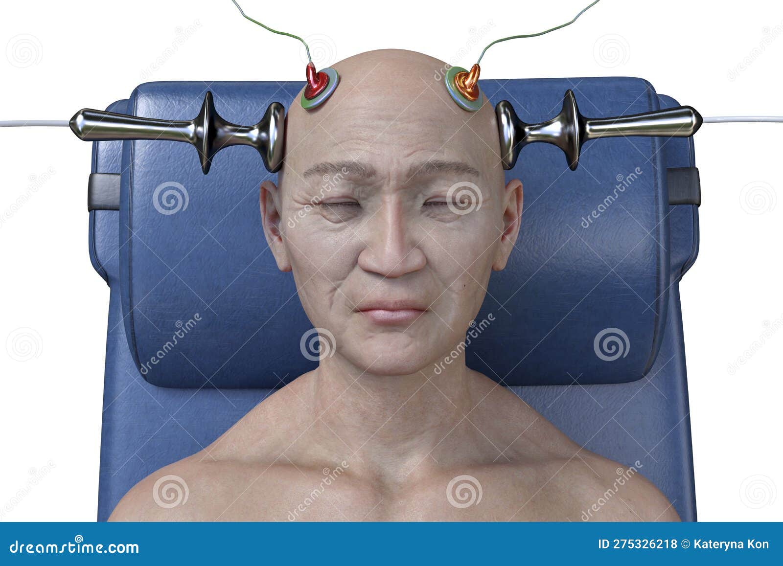 Electroconvulsive Therapy, ECT, a Treatment Involving the Use of ...