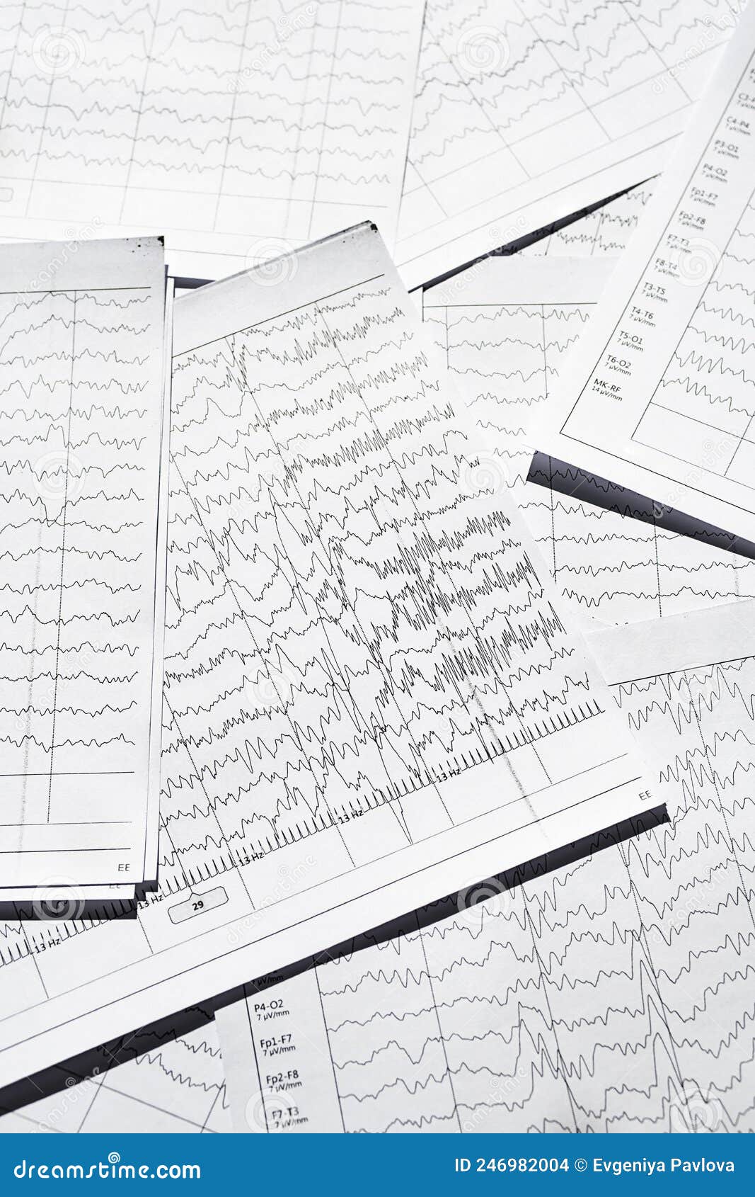 Brain Wave On Electroencephalogram, EEG Chart, EEG Of Children`s Brain ... Brain Wave On Electroencephalogram, EEG Chart, EEG Of Children`s Brain ...