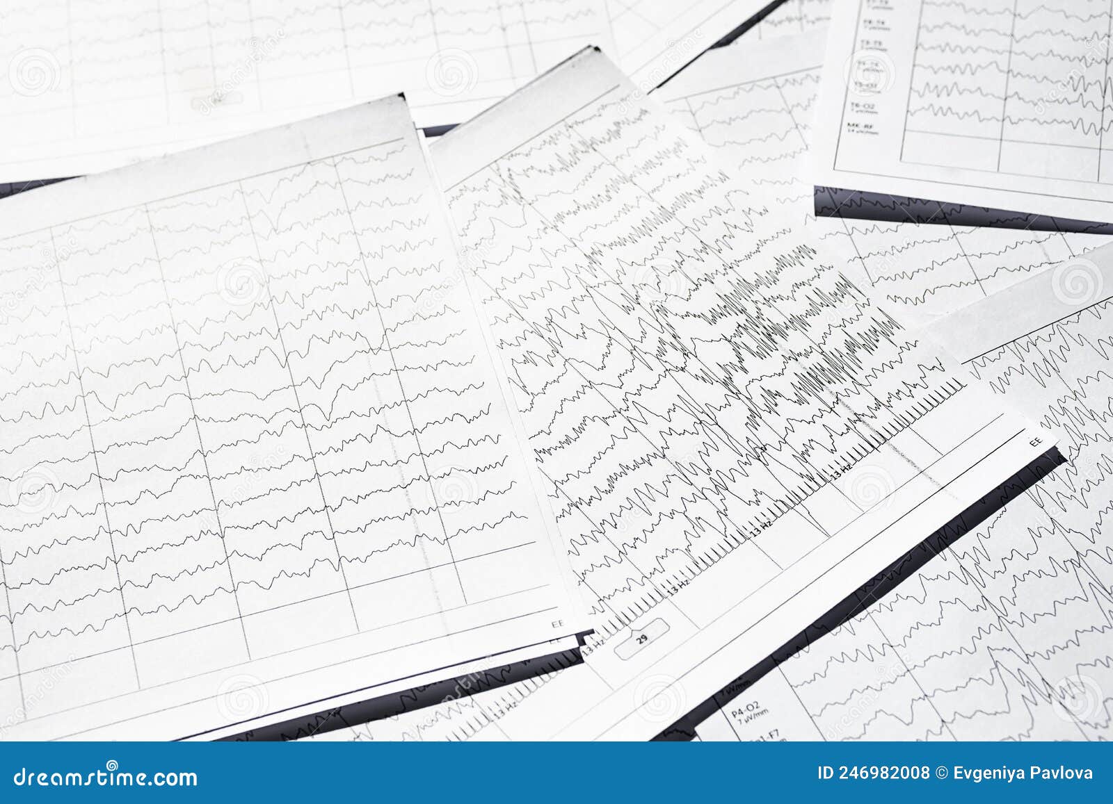 Electroencephalogram Diagnostic Rezults after Epilepsy. Brain Wave ...