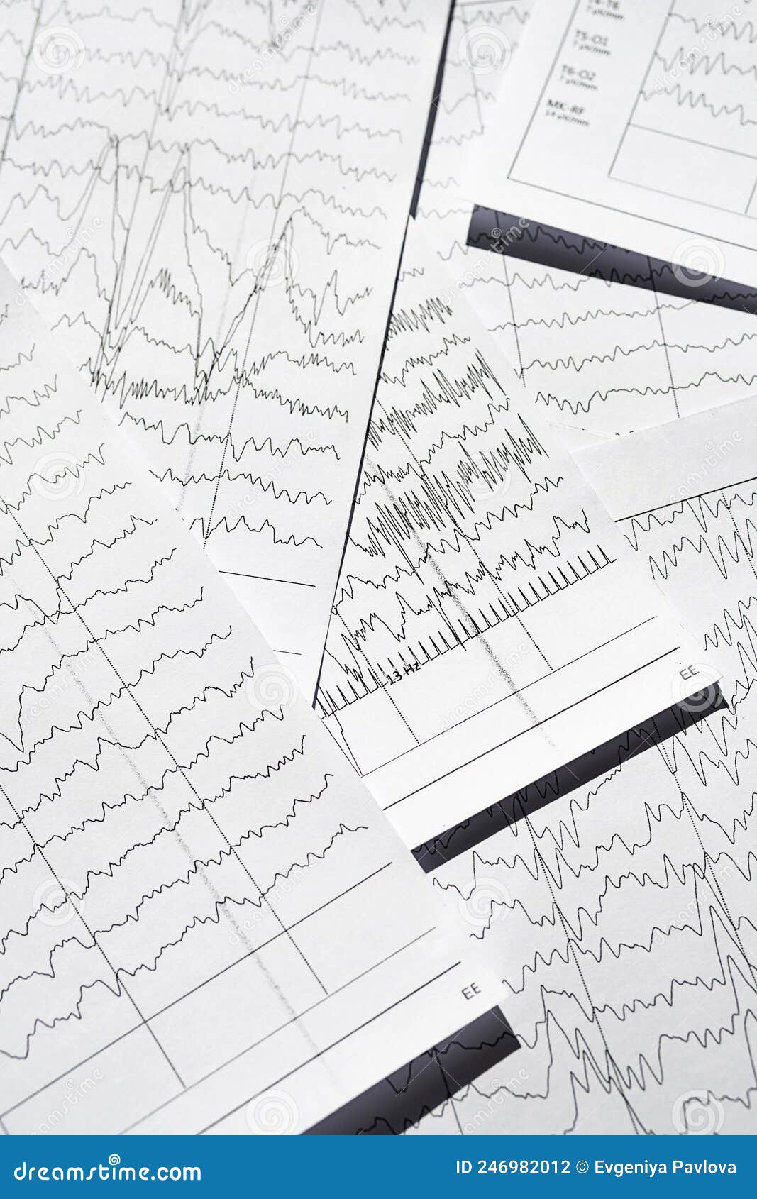 Brain Wave On Electroencephalogram, EEG Chart, EEG Of Children`s Brain ...