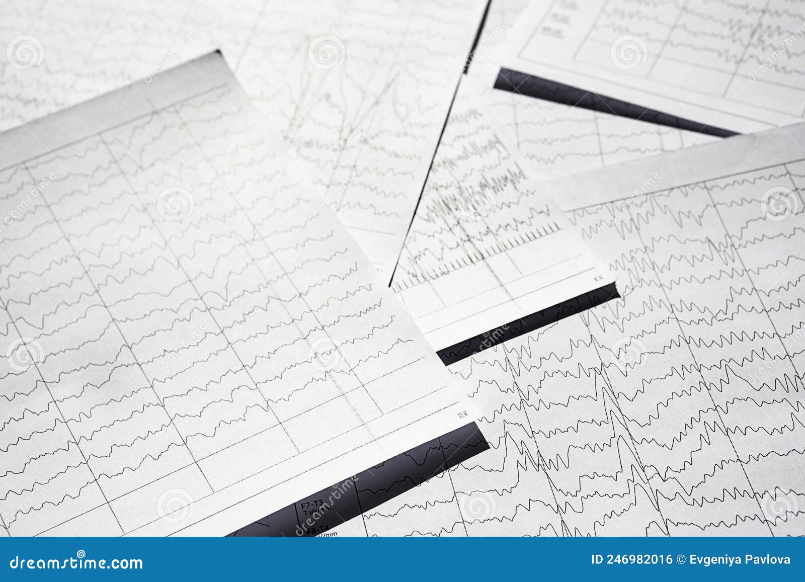 Brain Wave On Electroencephalogram, EEG Chart, EEG Of Children`s Brain ...