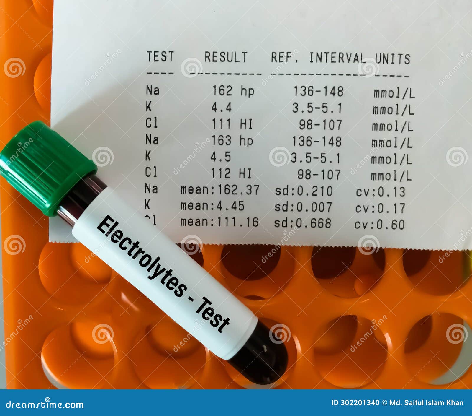 Electrolytes Test with Abnormal Report, Hypernatremia Stock Photo ...