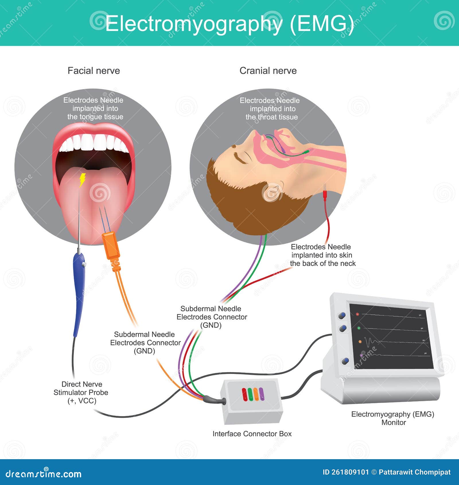 Electromyography. a Technique Medical. Stock Vector - Illustration of ...