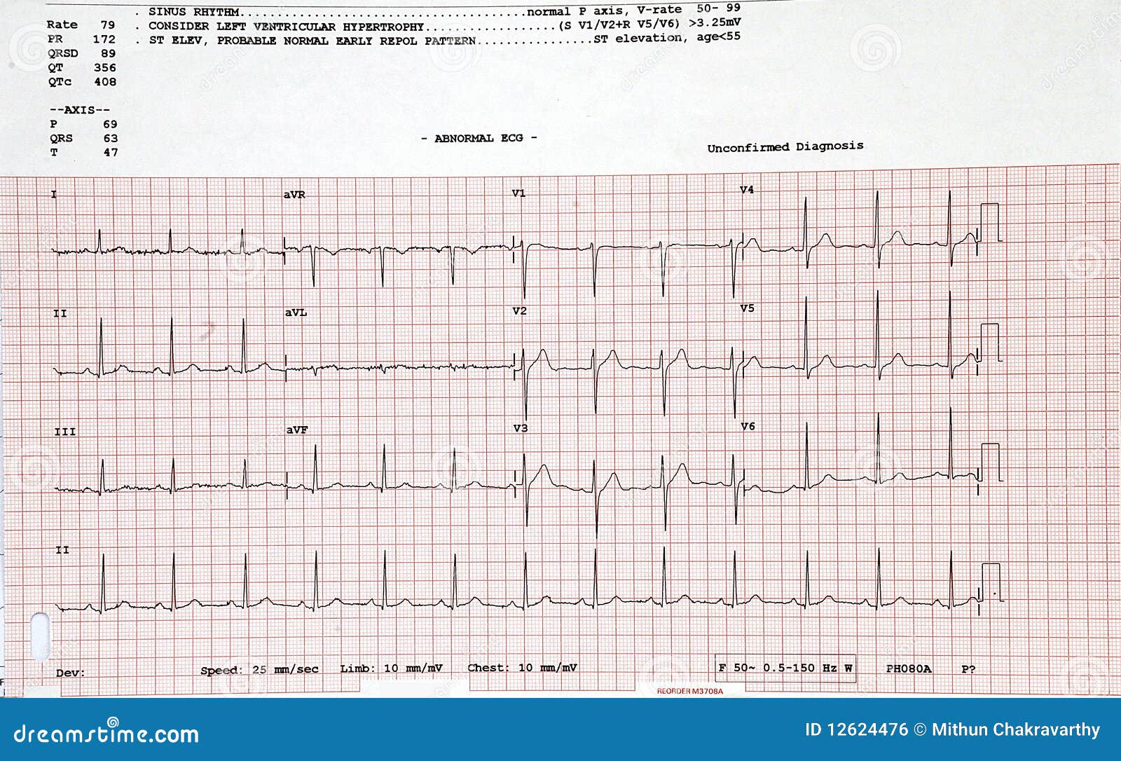 Elektrocardiogram stock foto. Image of leven, elektrocardiogram - 12624476