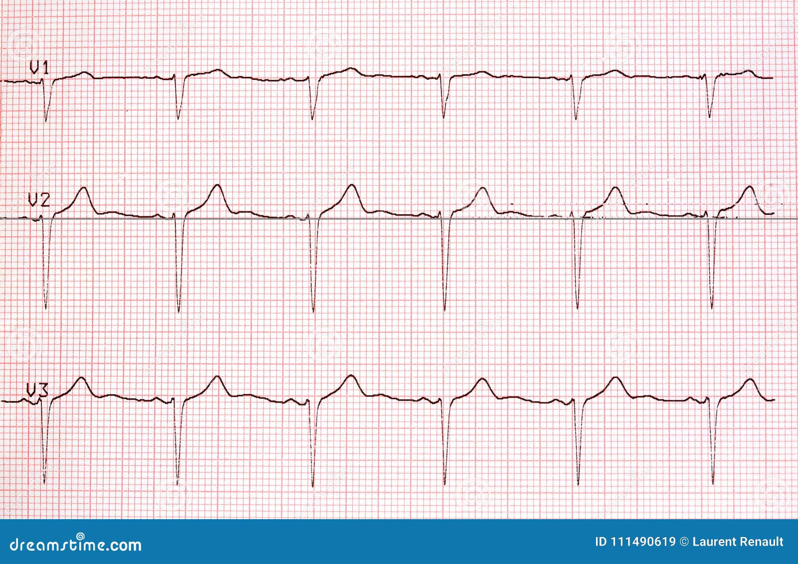Elektrocardiogramgrafiek Op Papier Stock Afbeelding - Image of elektro ...