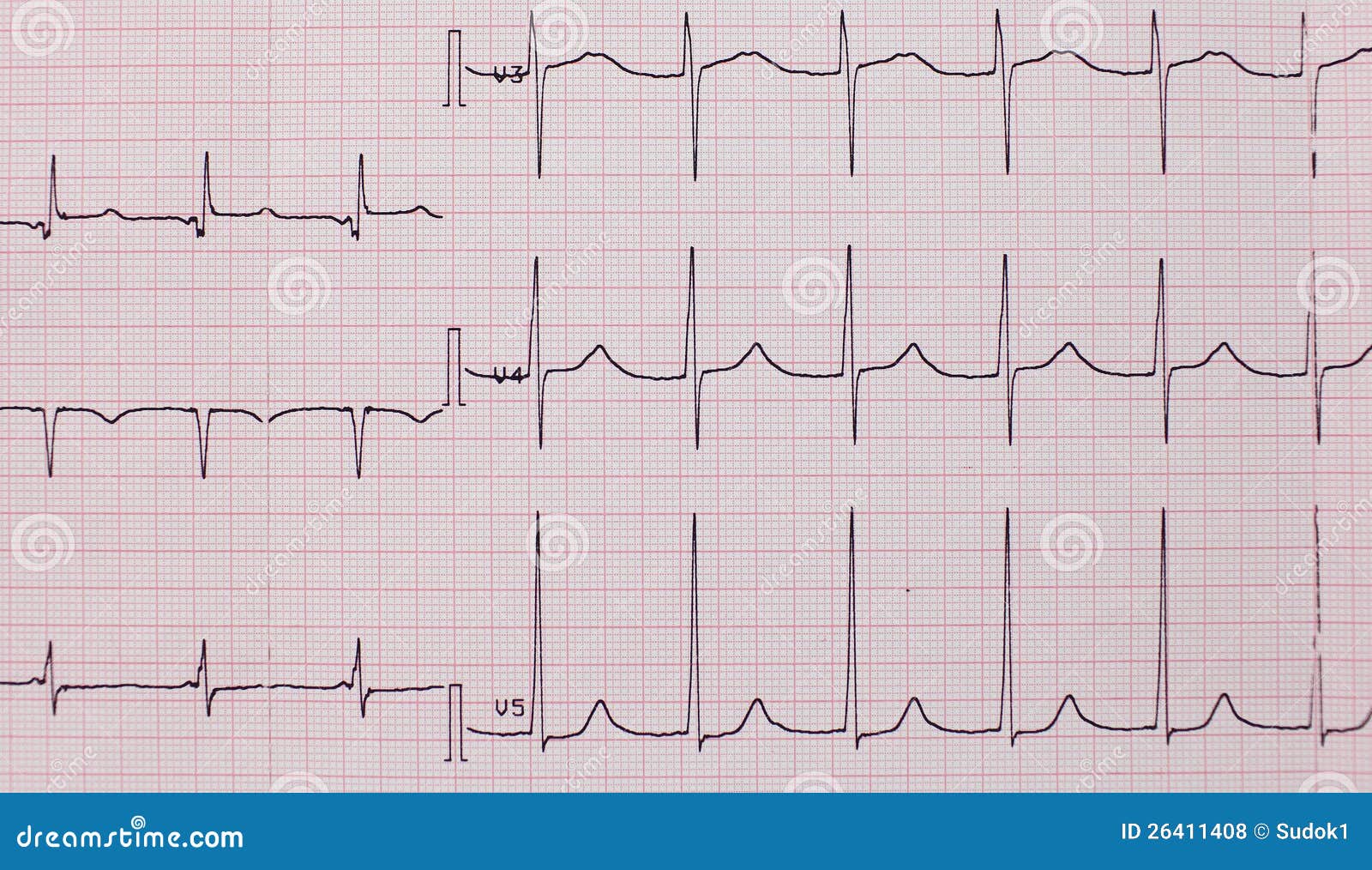 Elektrokardiogramm Des Patienten Lizenzfreie Stockfotos - Bild: 26411408