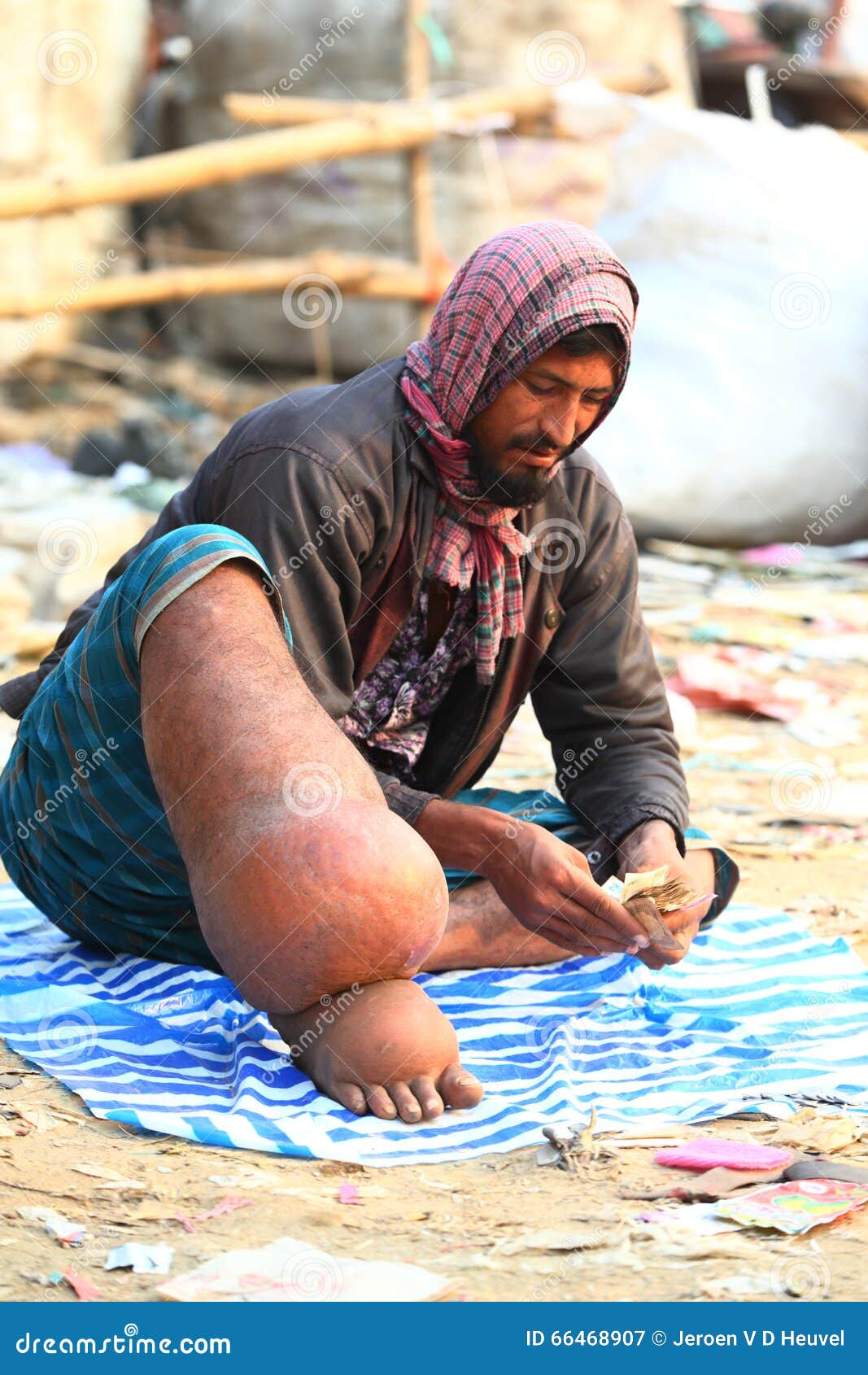 Elephantiasis editorial photography. Image of begging - 66468907
