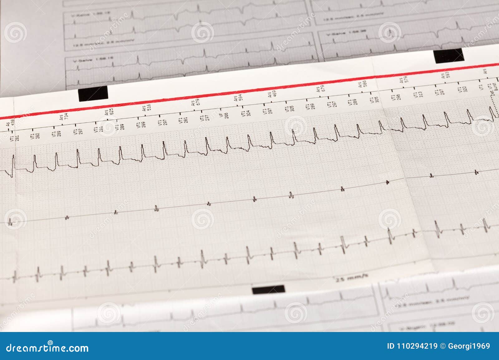Elettrocardiogramma ECG/elettrocardiogramma Con Aritmia Cardiaca ...