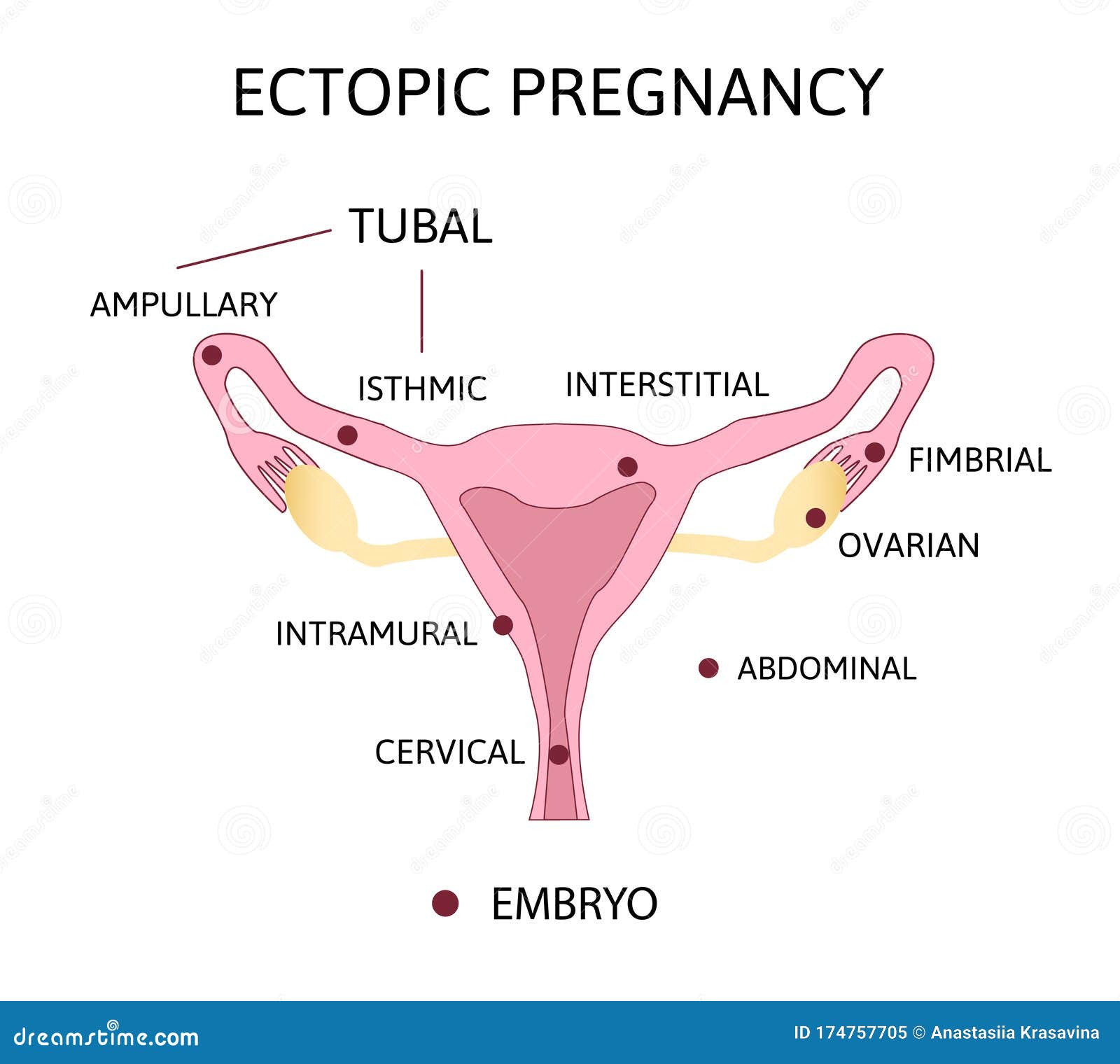 Embarazo Ectópico Tipos De Embarazo Tubárico Abdominal Ovárico Stock