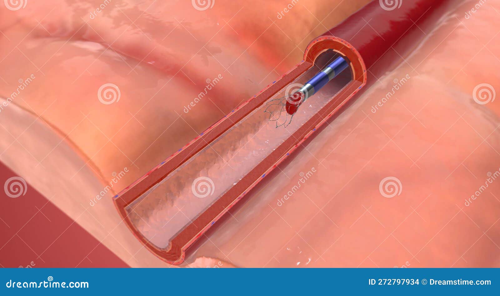 In Embolectomy Inside the Body Stock Illustration - Illustration of ...