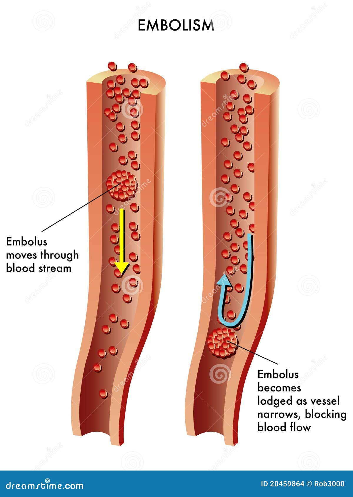 Embolie vector illustratie. Illustration of aanval, klonter - 20459864