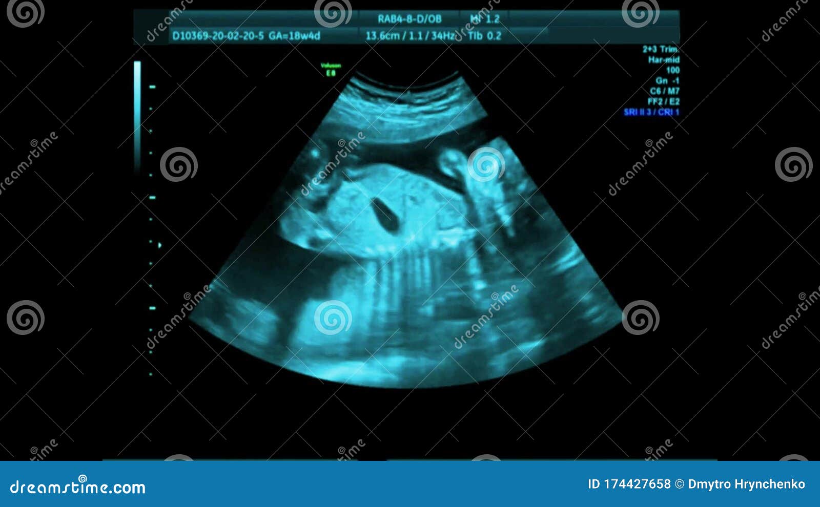 Embryo Computer Scanning Screen Cast. Pregnancy and Maternity Care ...