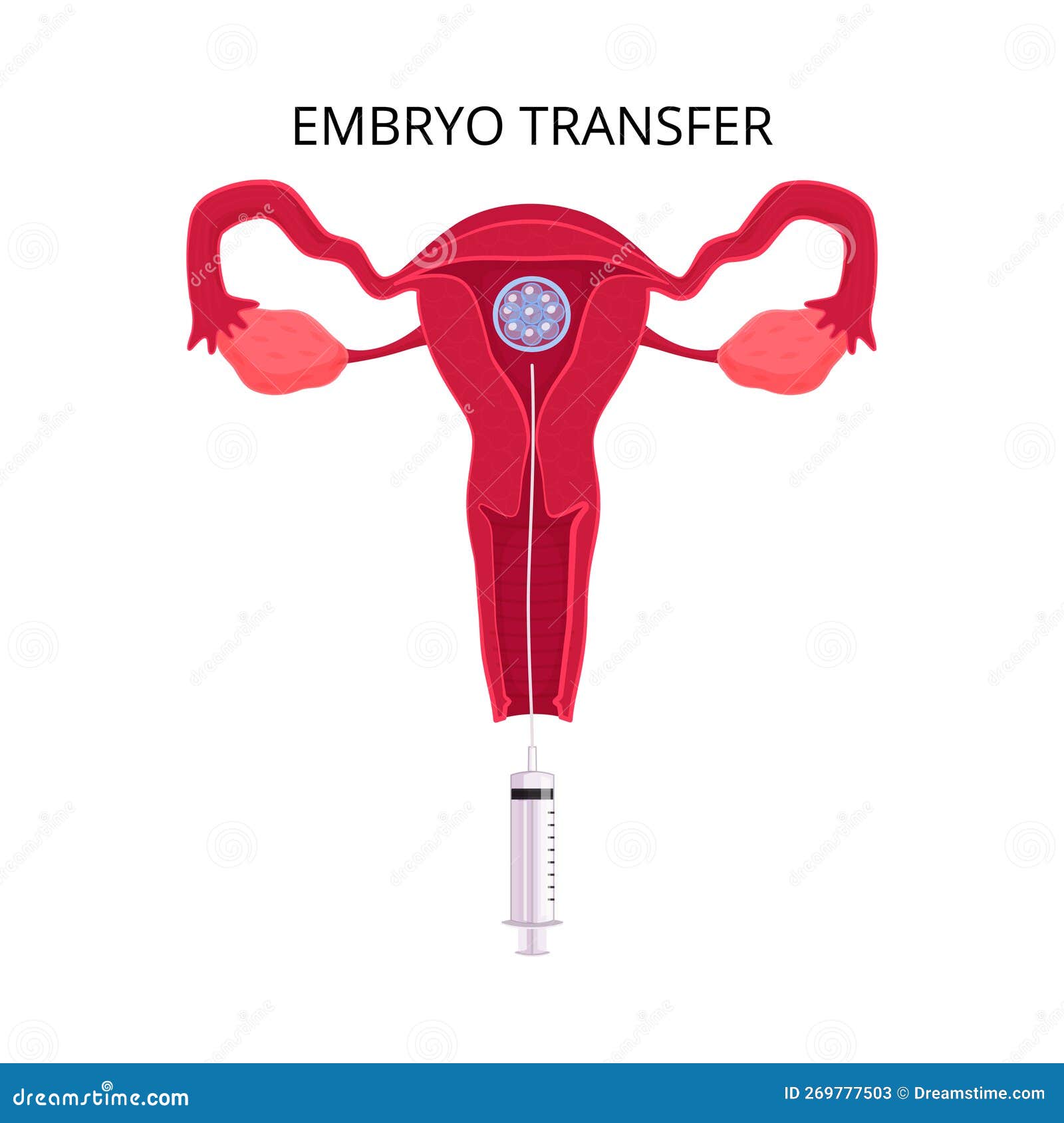 Embryo Transfer Flat Composition Stock Vector - Illustration of donor ...