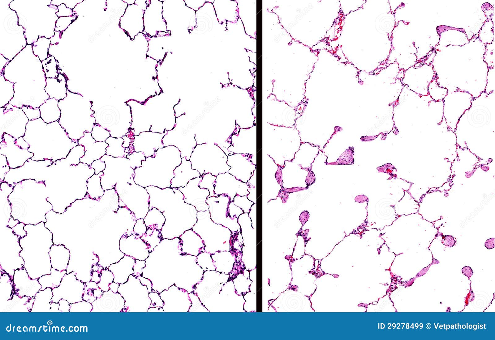 Emfyseem in de longen stock afbeelding. Image of adem - 29278499