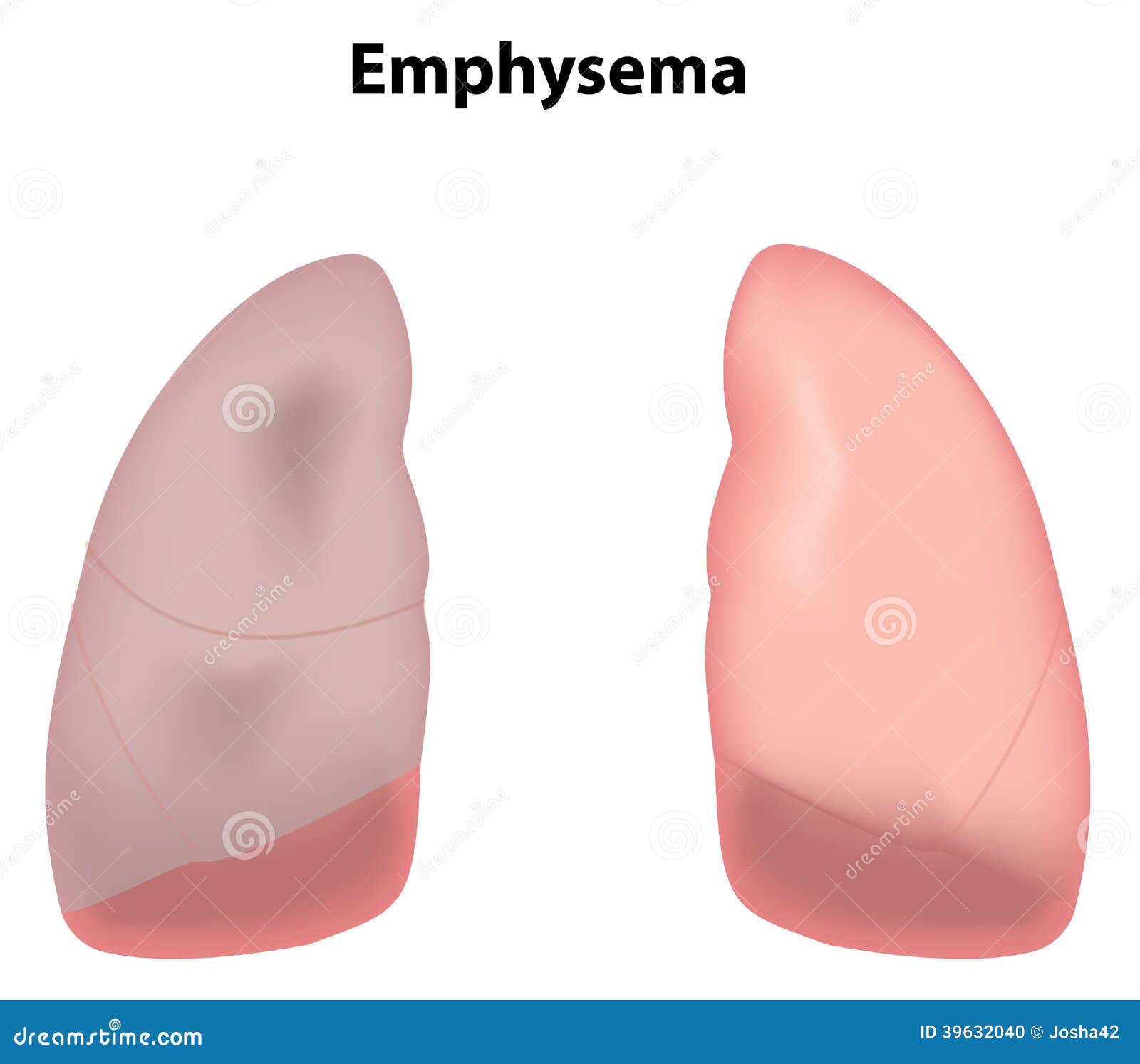 Emfyseem van de Longen vector illustratie. Illustration of borst - 39632040
