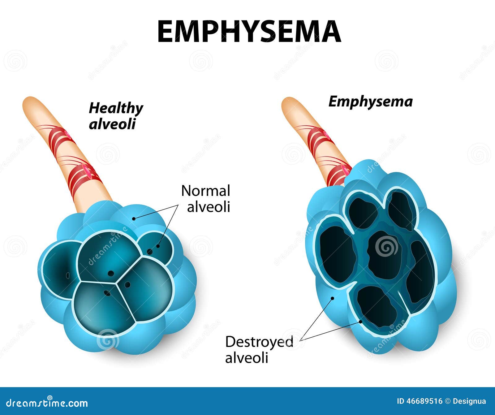 Emphysema vektor illustrationer. Illustration av utbyte - 46689516