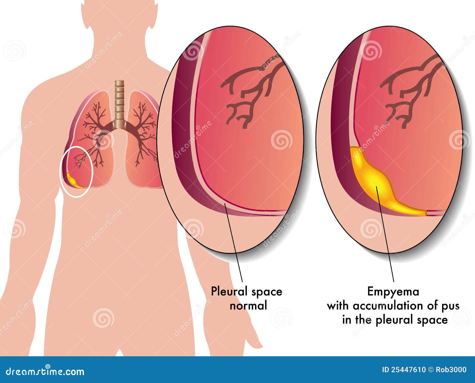Empiema Pleural Foto de archivo - Imagen: 25447610